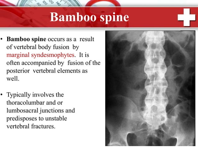 Ankylosing spondylitis by dr ashutosh | PPT