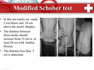 Ankylosing spondylitis by dr ashutosh | PPT