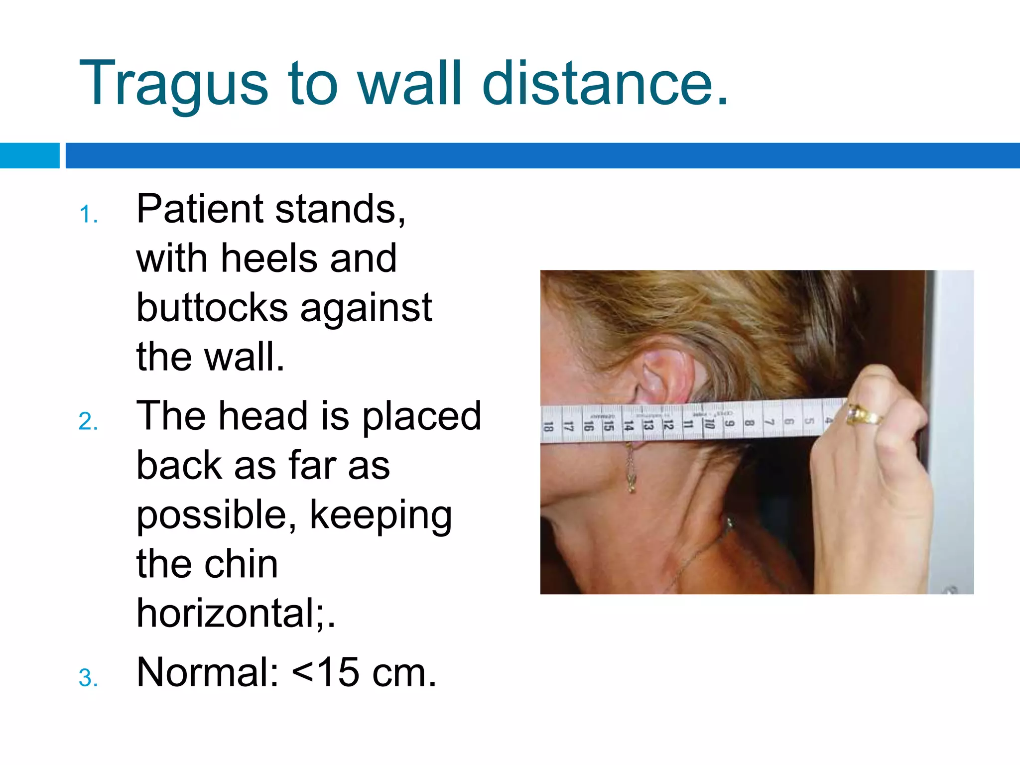 Ankylosing spondylitis clinical feature and diagnosis | PPTX