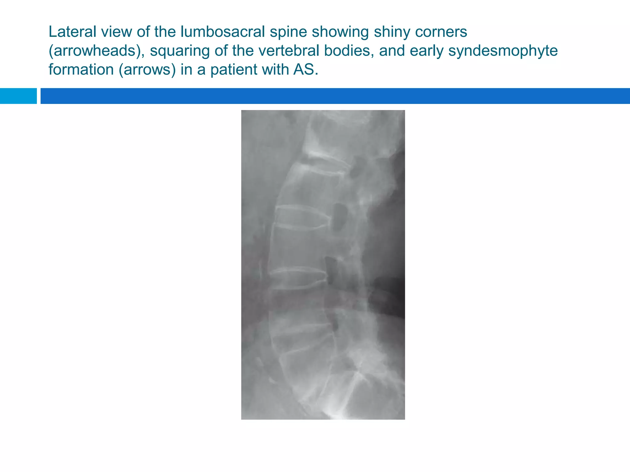 Ankylosing spondylitis clinical feature and diagnosis | PPTX