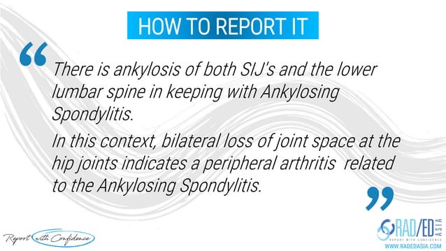 Ankylosing spondylitis hip peripheral joint involvement | PDF