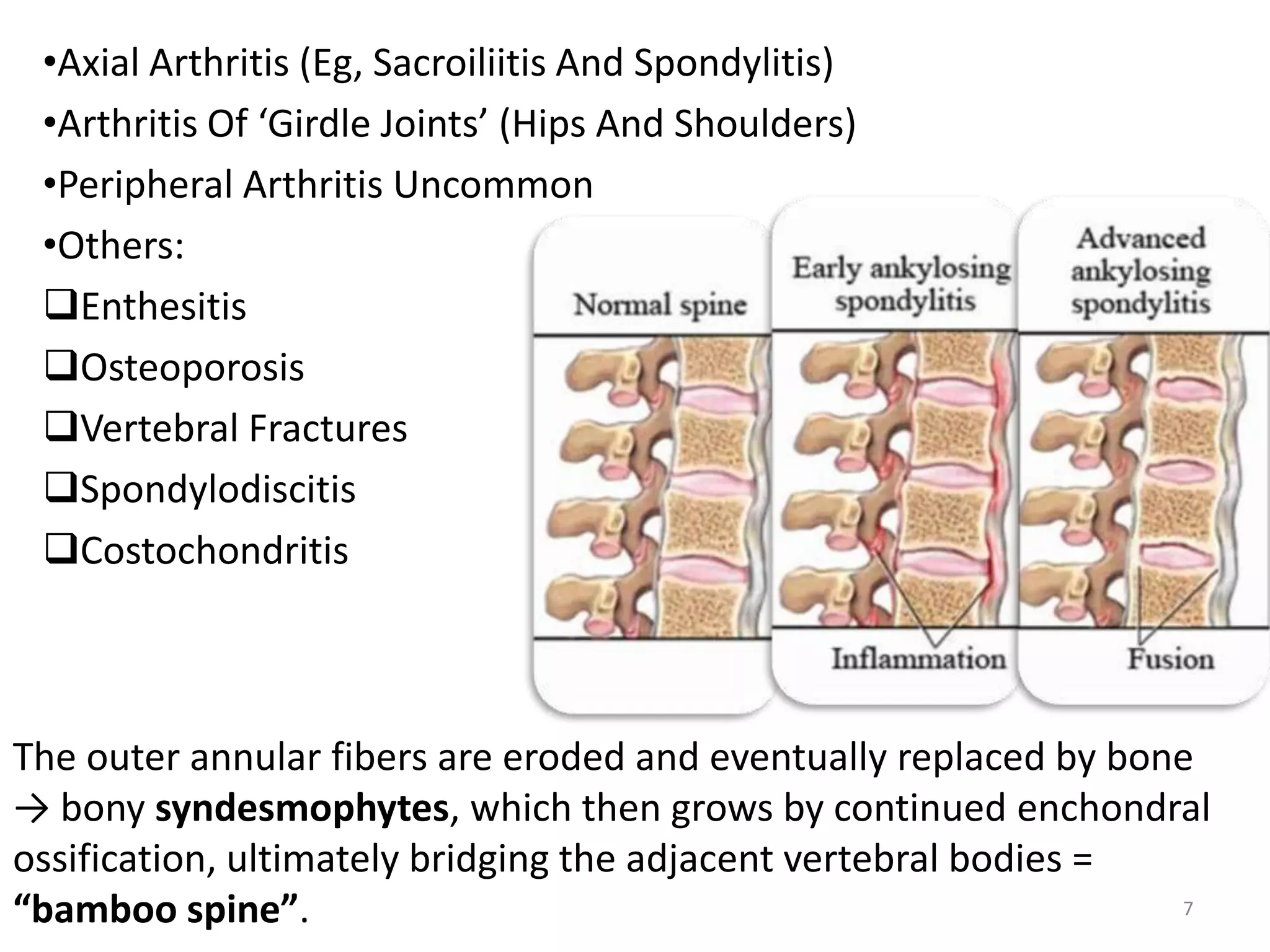 Ankylosing spondylitis UG lecture | PPTX