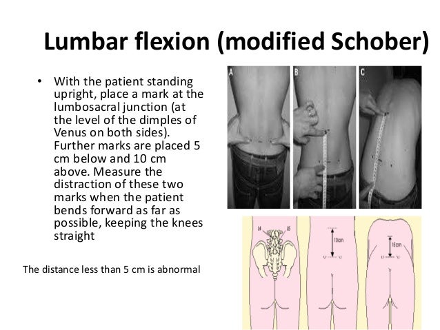 Ankylosing spondylitis UG lecture