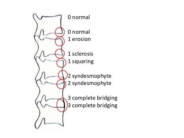Ankylosing spondylitis UG lecture