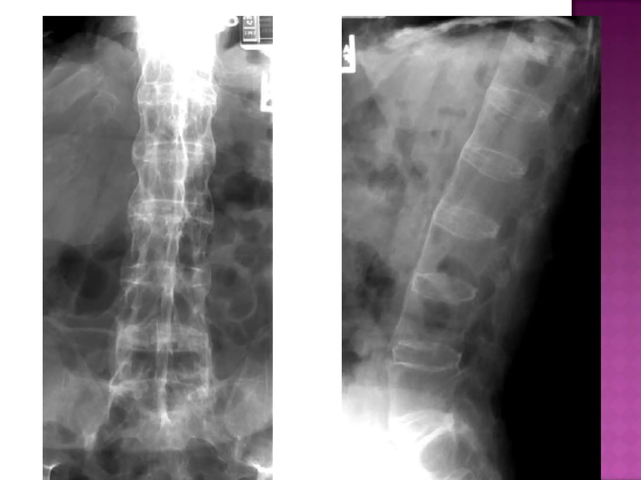 Ankylosing spondylitis pathogenesis | PPT