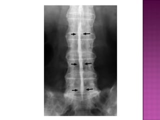 Ankylosing spondylitis pathogenesis | PPT
