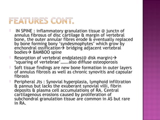 Ankylosing spondylitis pathogenesis | PPT