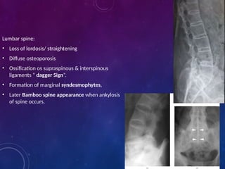 ankylosingspondylitis pk.pptx.............. | PPTX