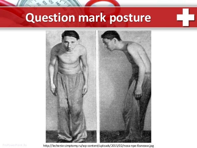 Ankylosing spondylitis. Self study materials for medical students.