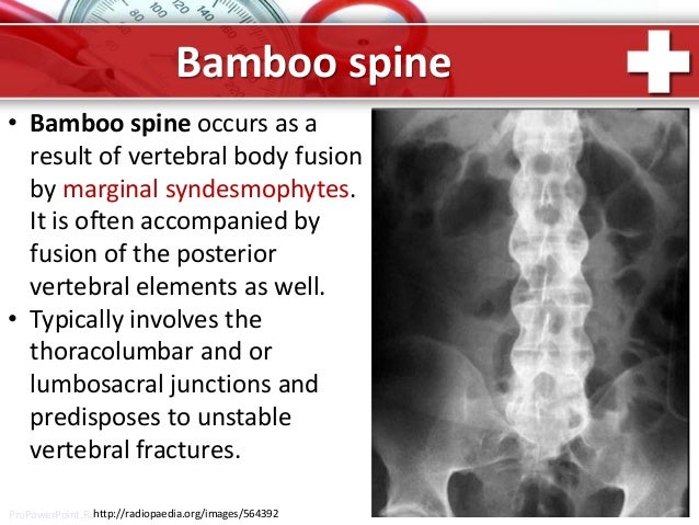 Ankylosing spondylitis. Self study materials for medical students.