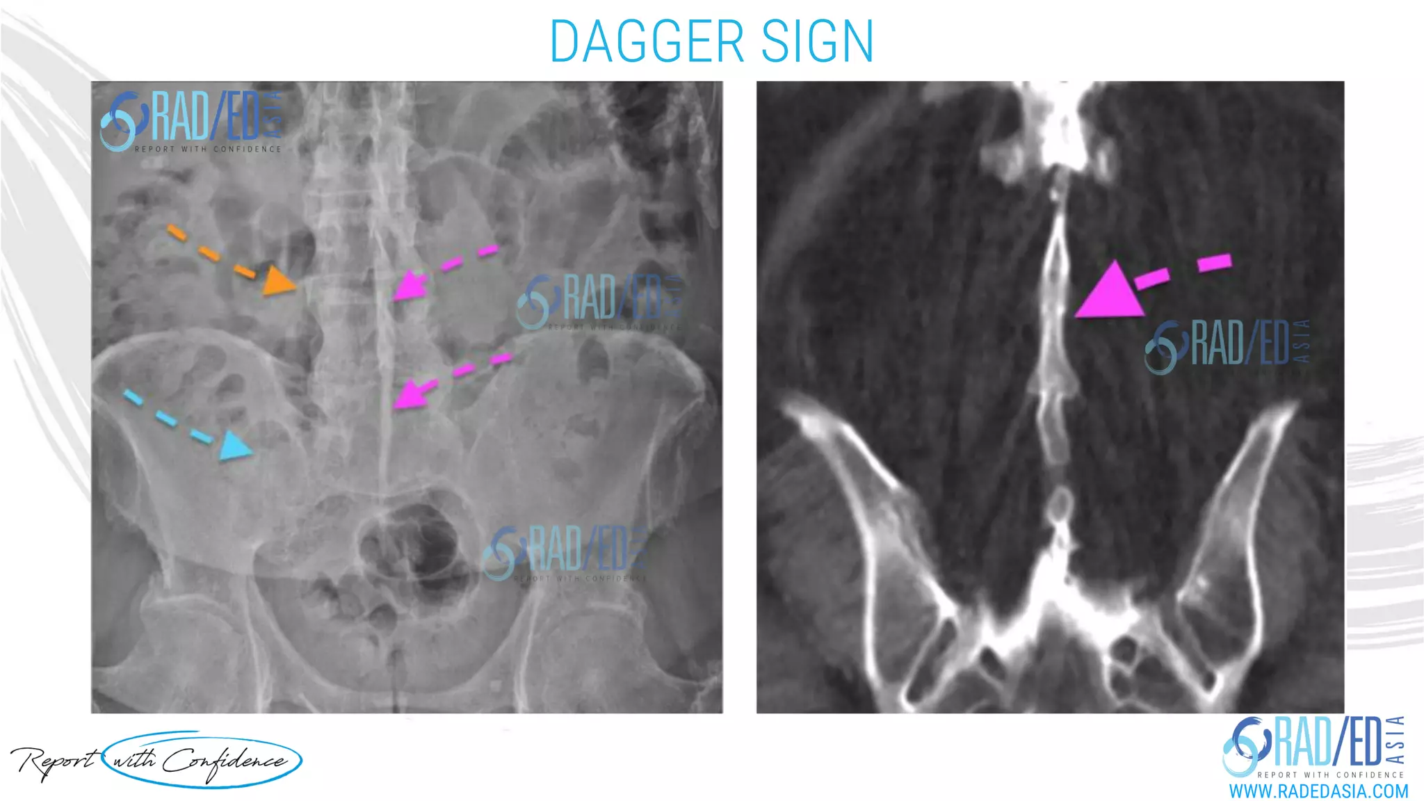 ANKYLOSING SPONDYLITIS SPINE IMAGING DAGGER SIGN RADEDASIA | PPT