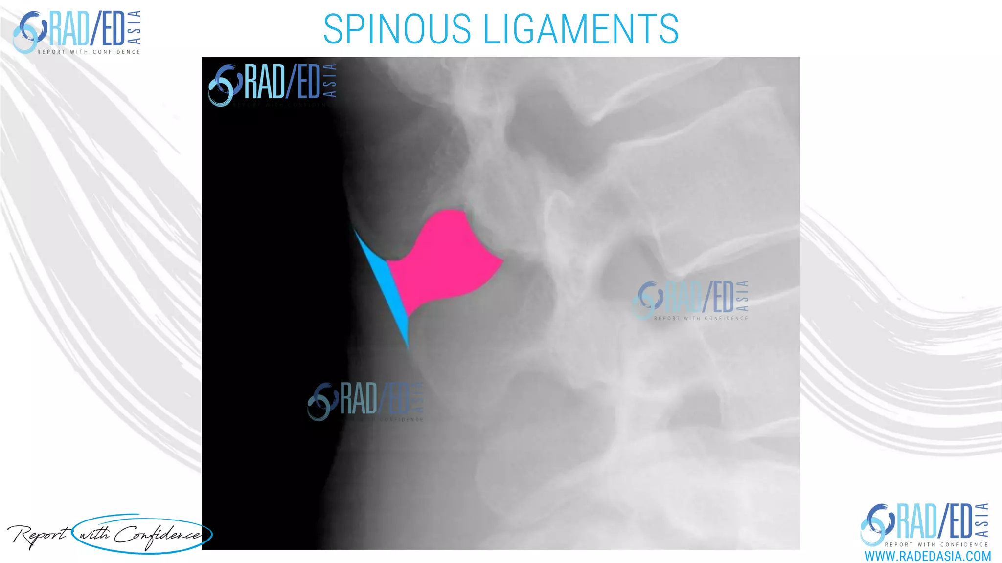 ANKYLOSING SPONDYLITIS SPINE IMAGING DAGGER SIGN RADEDASIA | PPT