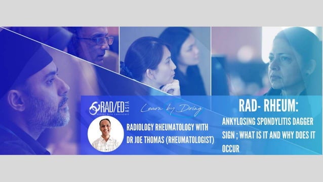 ANKYLOSING SPONDYLITIS SPINE IMAGING DAGGER SIGN RADEDASIA | PPT | Free ...