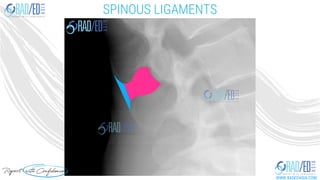 ANKYLOSING SPONDYLITIS SPINE IMAGING DAGGER SIGN RADEDASIA | PDF