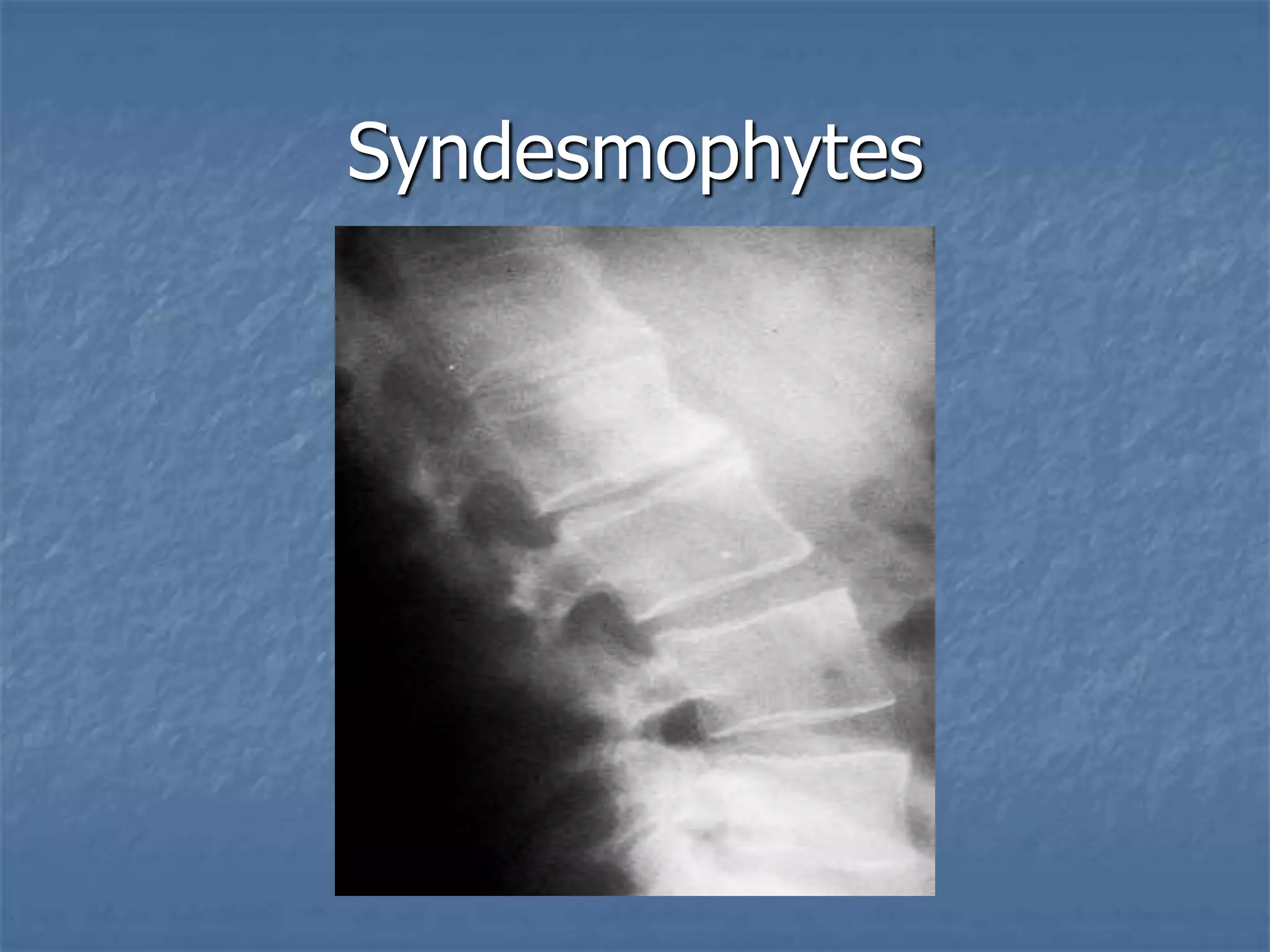 Ankylosing spondylosis and physiotherapy- Dr Gurjant Singh (PT) | PPTX