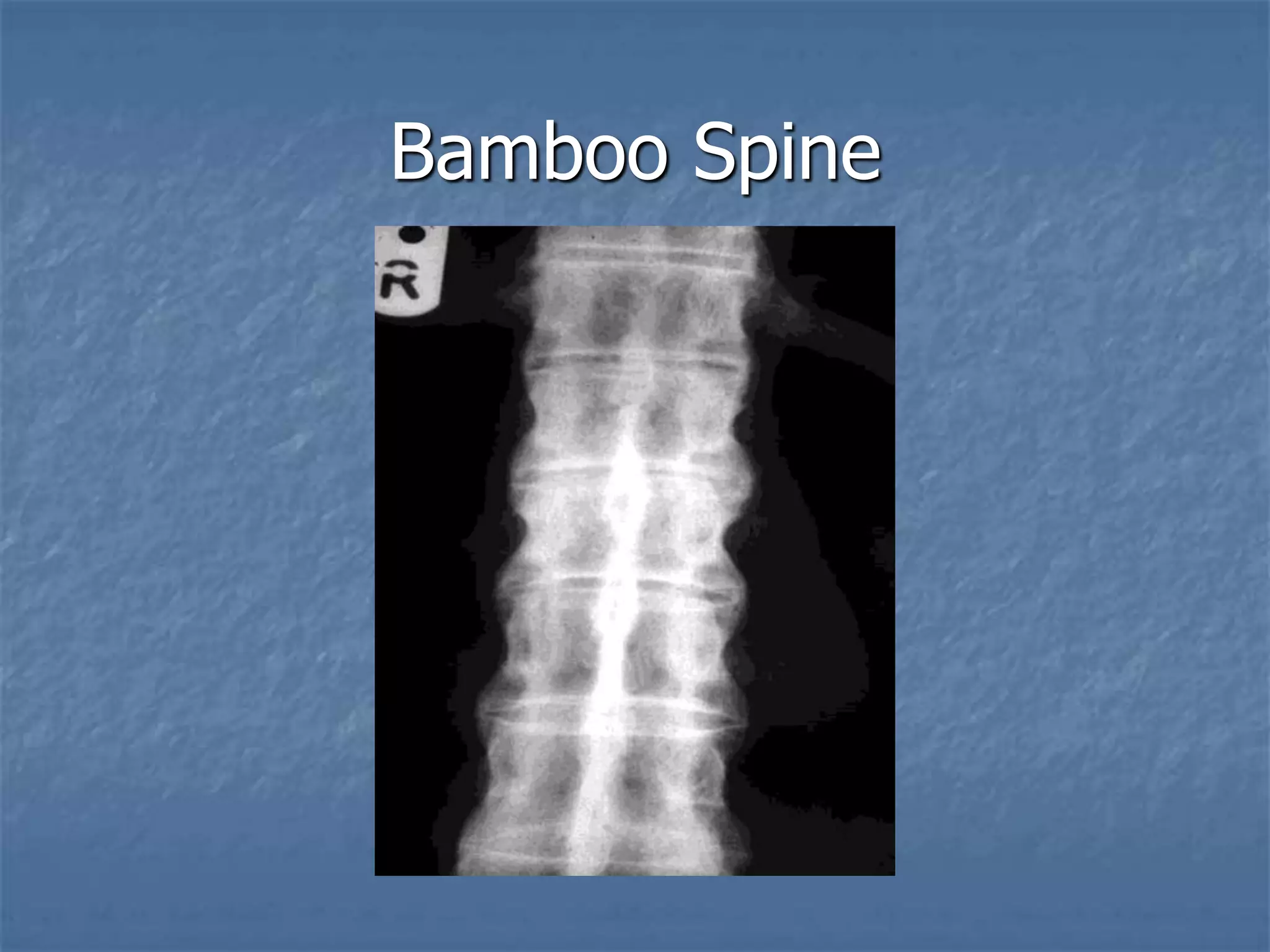 Ankylosing spondylosis and physiotherapy- Dr Gurjant Singh (PT) | PPTX