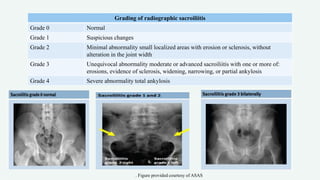 Ankylosing Spondylosis PPT.pptx