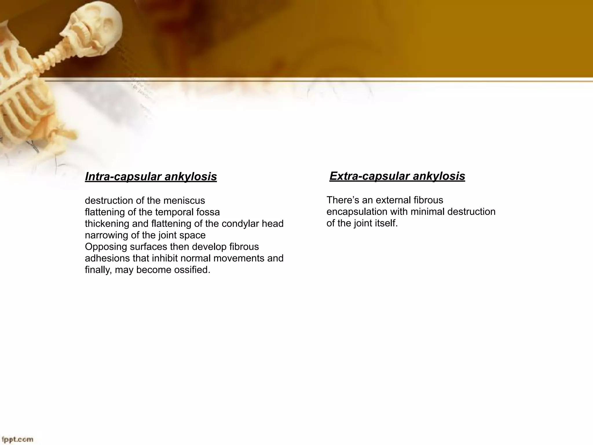 ANKYLOSIS OF TMJ.pdf