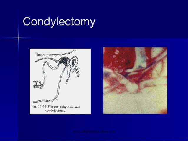 Ankylosis of temperomandibular joint