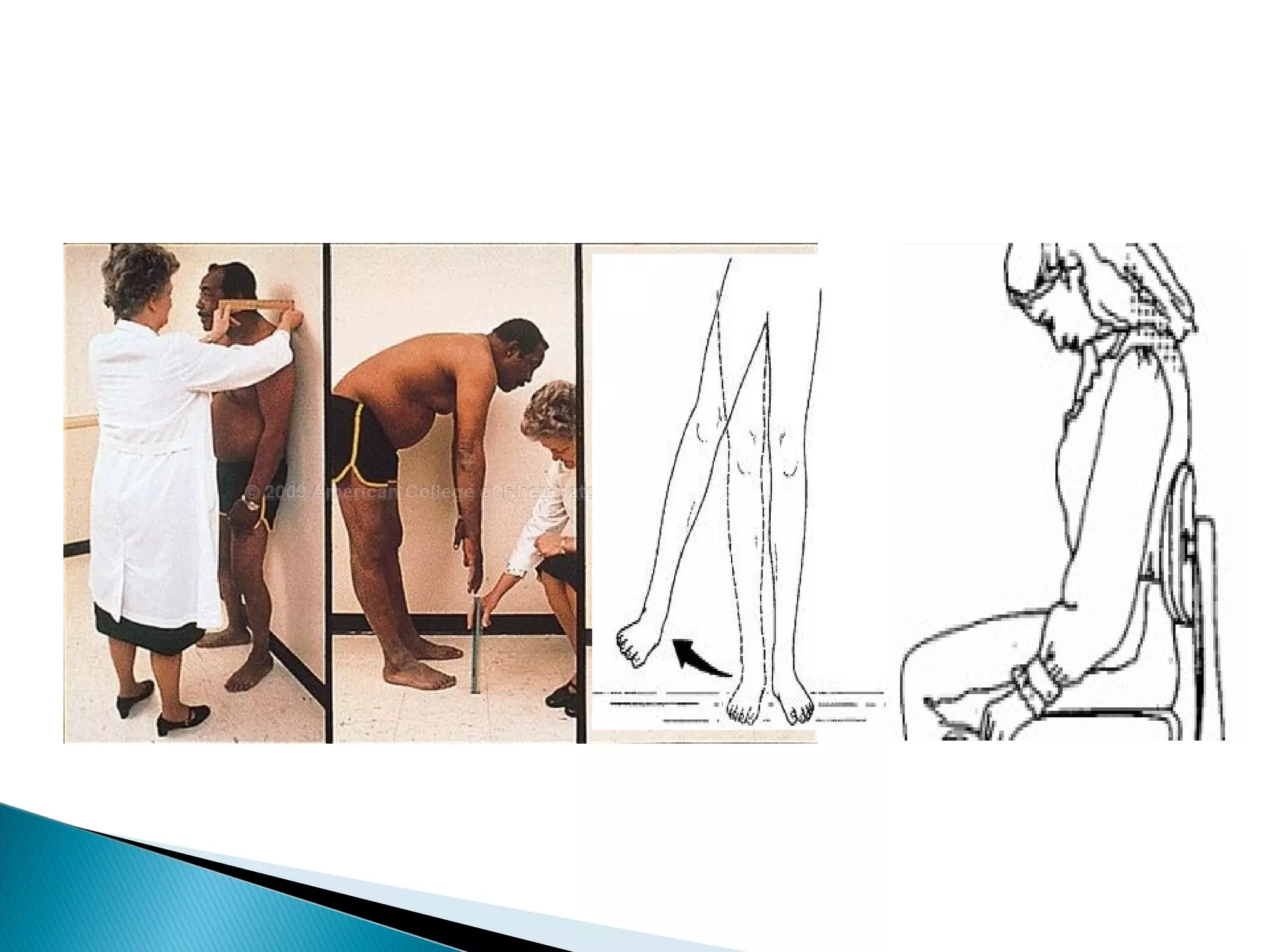 Ankylosing spondylitis clinical features | PPT