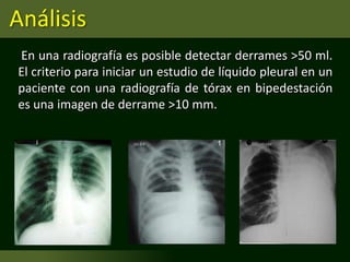 Análisis de líquido pleural | PPTX