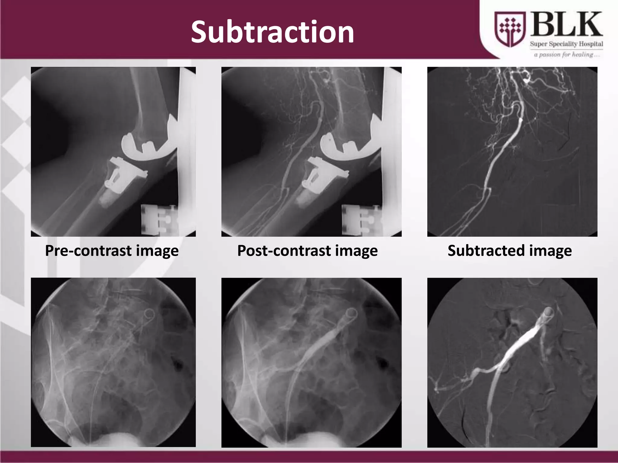 Vascular Interventions And Their Clinical Applications Pptx 9646