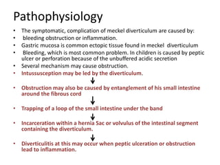 Meckel Diverticulum | PPTX