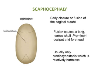 Annormalities of head size and shape | PPTX