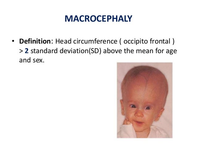 Benigni Benign Macrocephaly