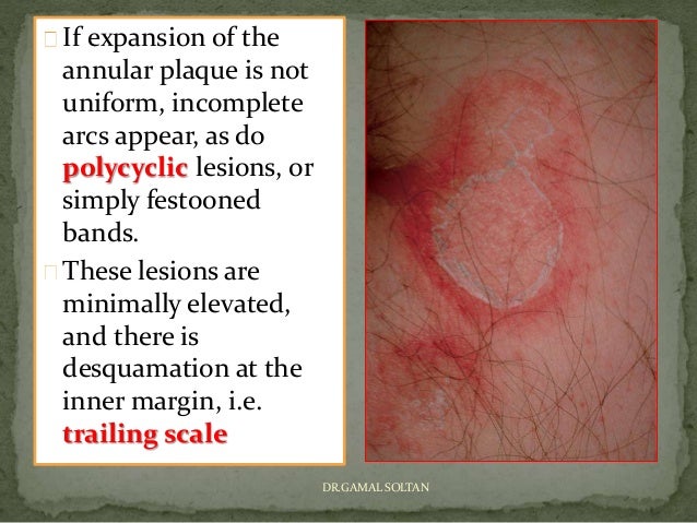 Annular erythema