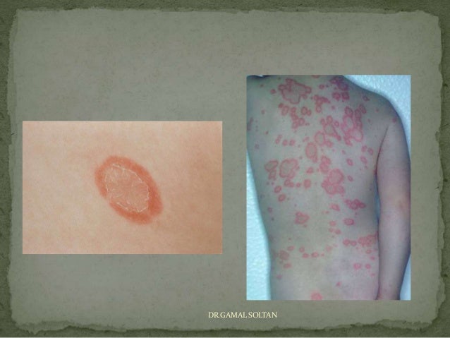 Annular erythema