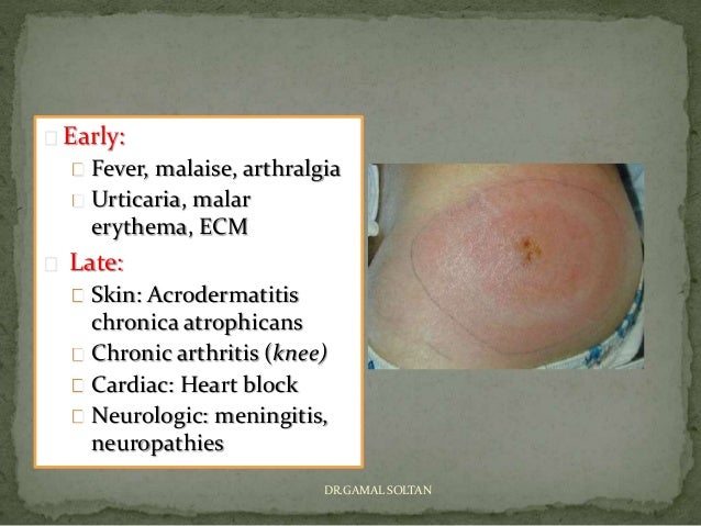 Annular erythema