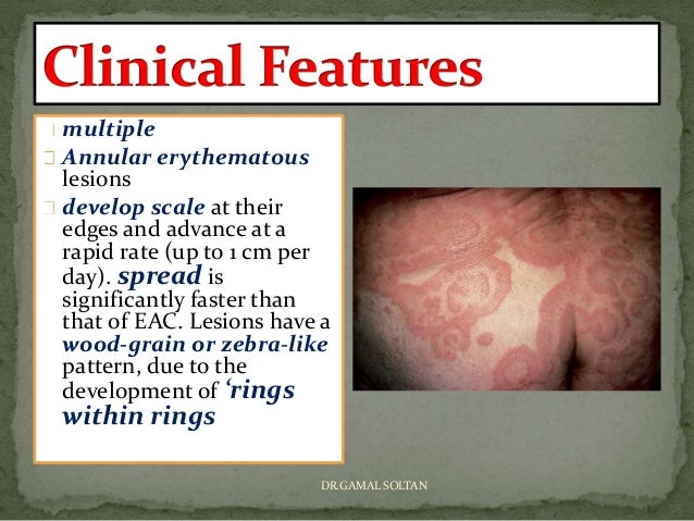 Annular erythema