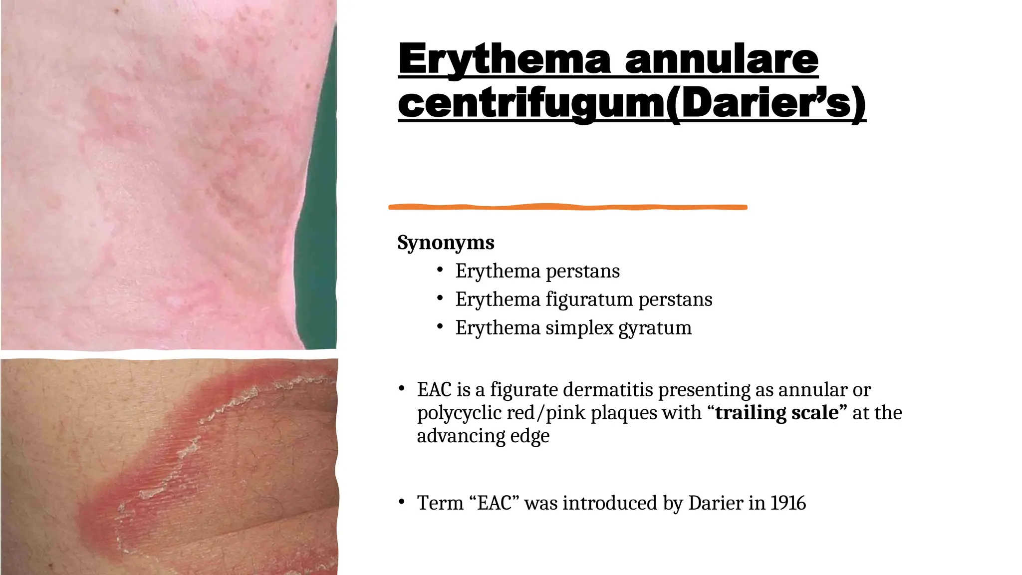 Annular erythema .Annular erythema is a descriptive term that ...