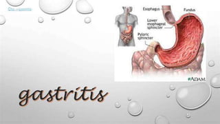 annus gastritis.pptx | Digestive Disorders | Diseases and Conditions