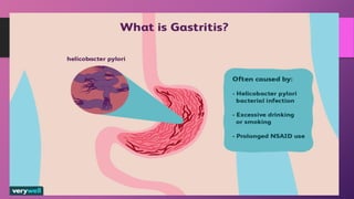 annus gastritis.pptx | Digestive Disorders | Diseases and Conditions