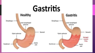 annus gastritis.pptx | Digestive Disorders | Diseases and Conditions