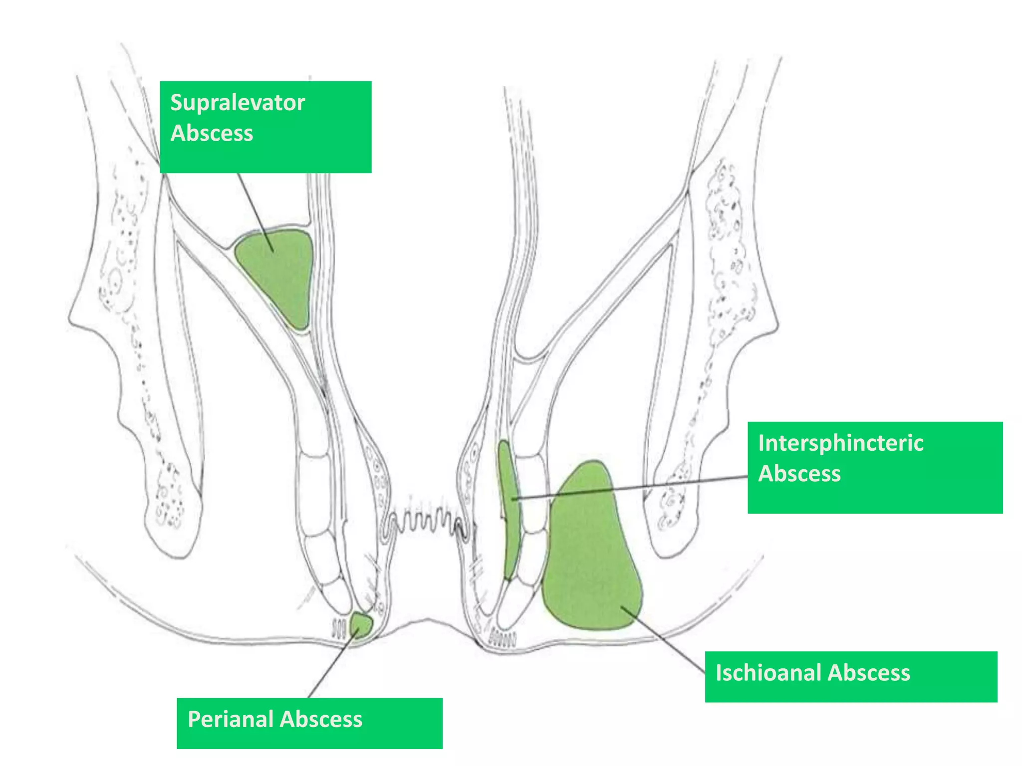 Ano rectal conditions | PPTX