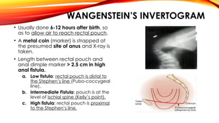 Anatomy of Rectum and Anal Canal with Ano-Rectal Malformations.pptx