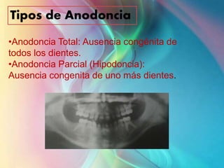 Anodoncia | PPTX