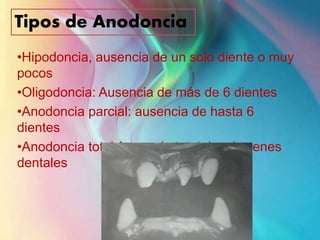 Anodoncia | PPTX