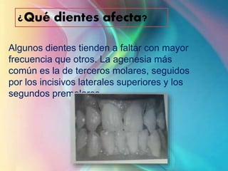 Anodoncia | PPTX