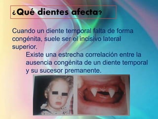 Anodoncia | PPTX
