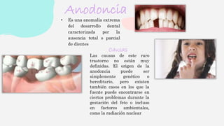 Anodoncia .pptx