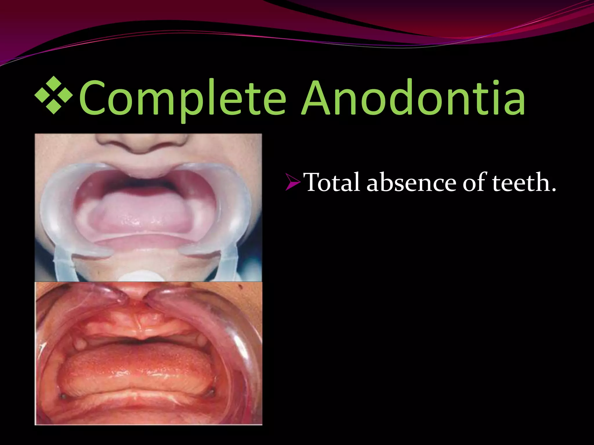 Anodontia | PPTX