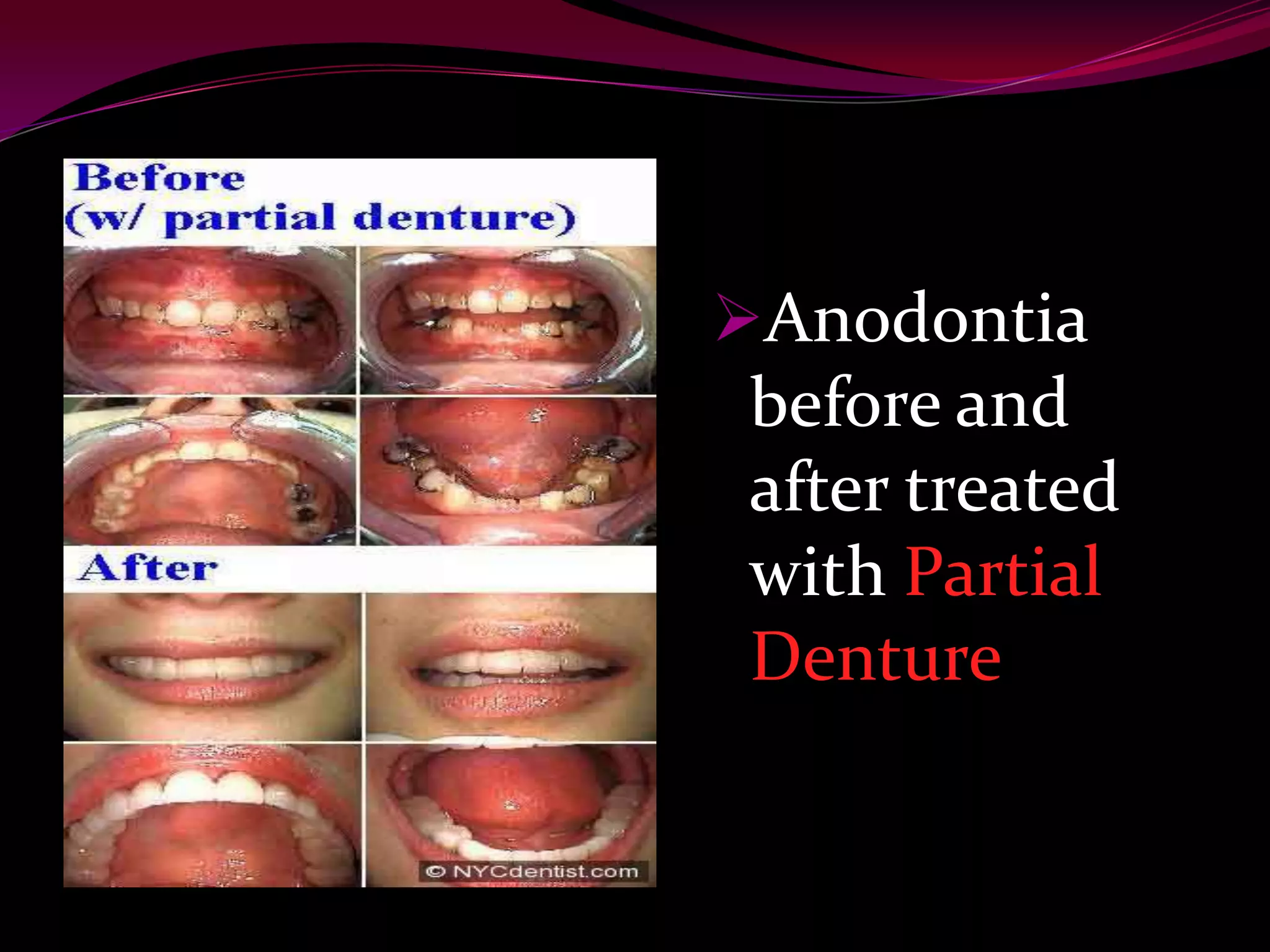 Anodontia | PPTX