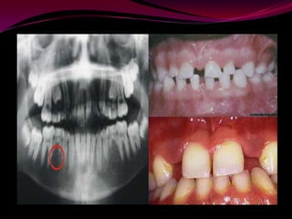 Anodontia Radiograph