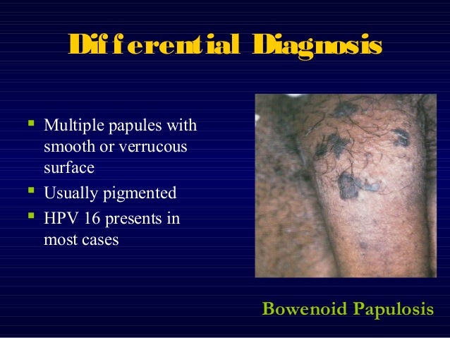 Anogeneital warts