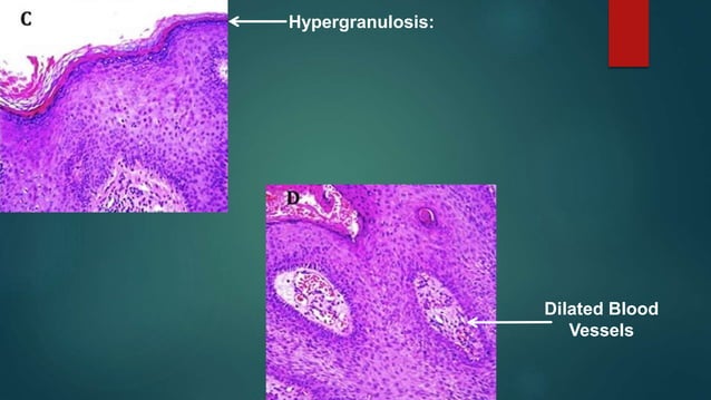 Anogenital warts | PPTX | Sexual Conditions | Sexual Health