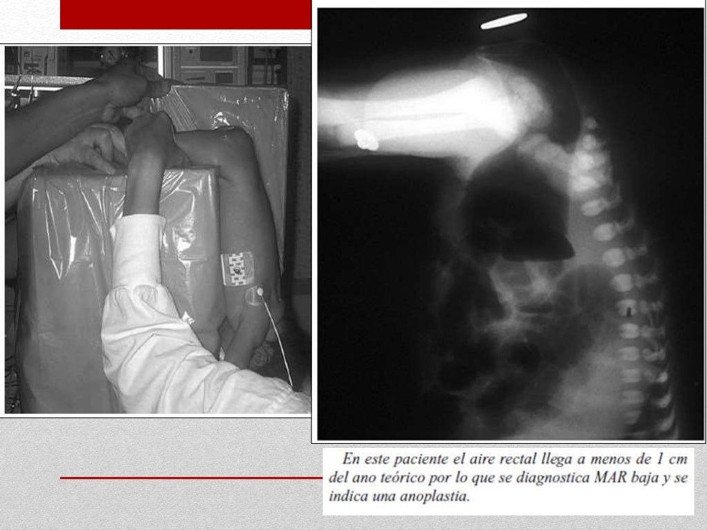 Ano Imperforado Externado de Cirugia USAC